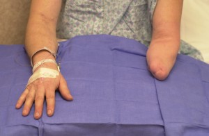 Hand Transplantation | Christine M. Kleinert Institute for Hand and ...